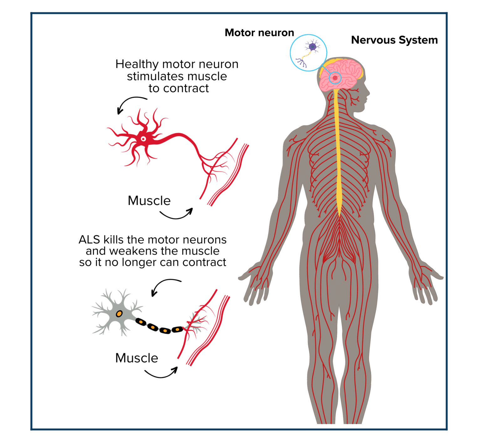 Understanding ALS: Symptoms, Causes, and Support | ALS United Greater NY