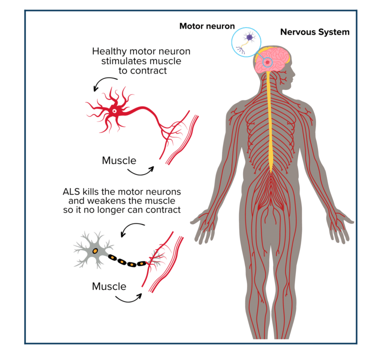Understanding ALS: Symptoms, Causes, and Support | ALS United Greater NY